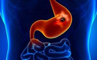 Ülser Nedir? Ülser Belirtileri Nelerdir? Tedavisi Nasıldır?